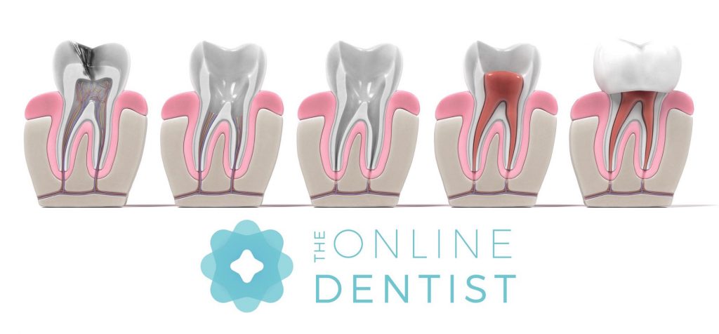 Stages of root canal treatment – Online Dentist